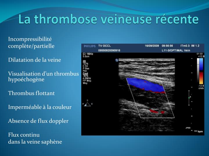 PPT - Thromboses veineuses : Aspects echo - dopplers PowerPoint ...