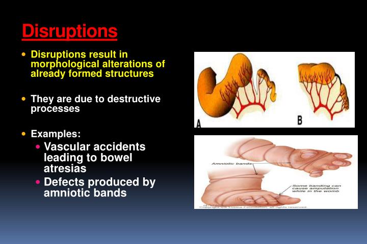 PPT - Birth defects PowerPoint Presentation - ID:5047175