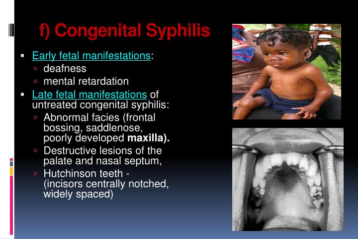 PPT - Birth defects PowerPoint Presentation - ID:5047175