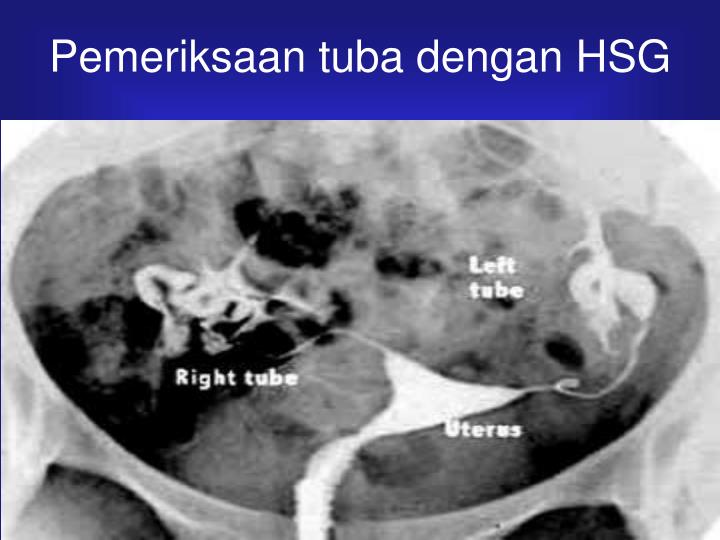 PPT - INFERTILITAS PowerPoint Presentation - ID:5078824