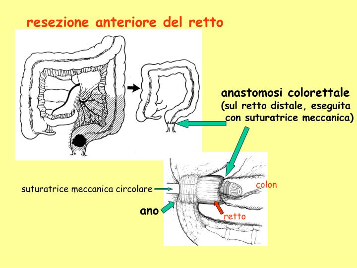 PPT - Polipo del colon, cancerizzato PowerPoint Presentation - ID:5090195