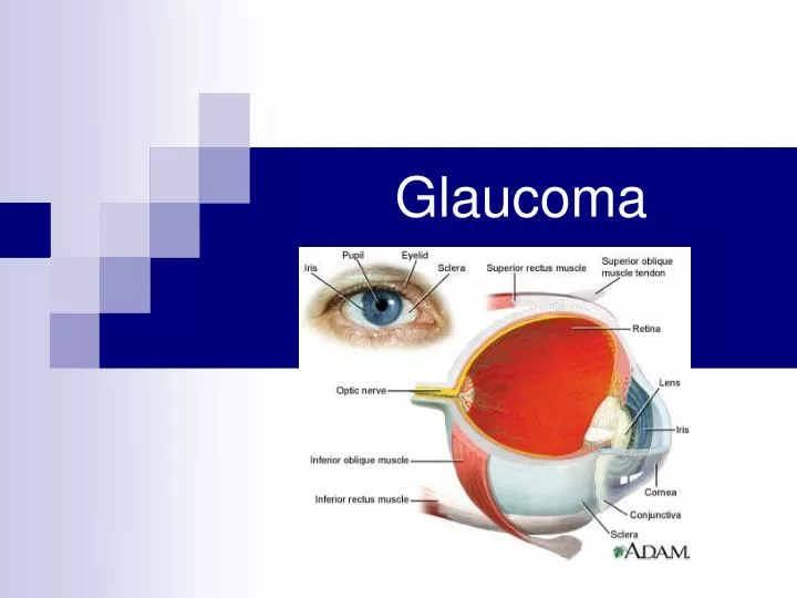 PPT - Glaucoma PowerPoint Presentation, free download - ID:5096621