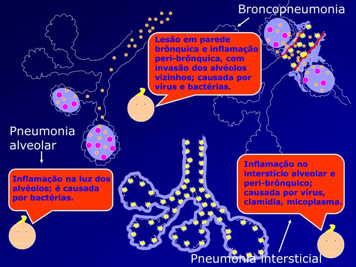 PPT - PNEUMONIAS NA CRIANÇA PowerPoint Presentation - ID:5099868