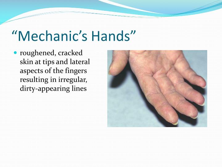 PPT - Dermatomyositis PowerPoint Presentation - ID:5103882
