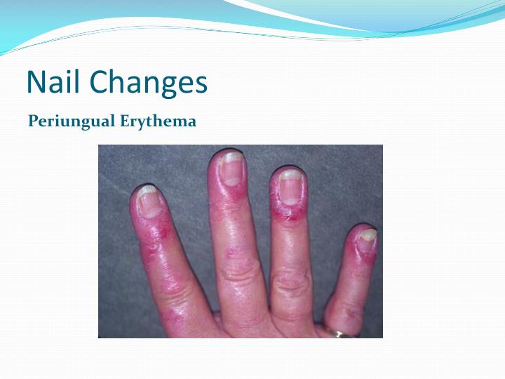 PPT - Dermatomyositis PowerPoint Presentation - ID:5103882