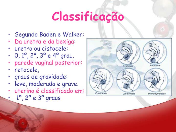 PPT - PROLAPSO VAGINAL PowerPoint Presentation - ID:5115444