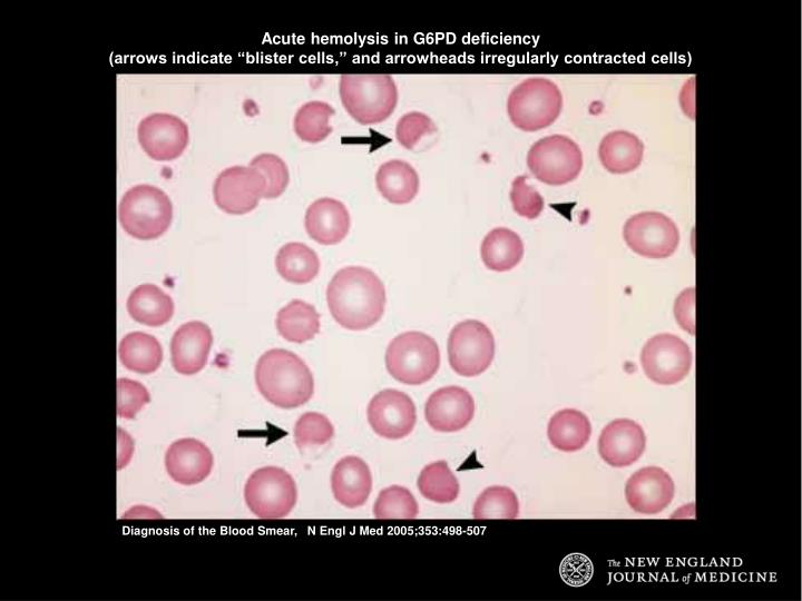 PPT - Diagnosis of the Blood Smear, N Engl J Med 2005;353:498-507 ...