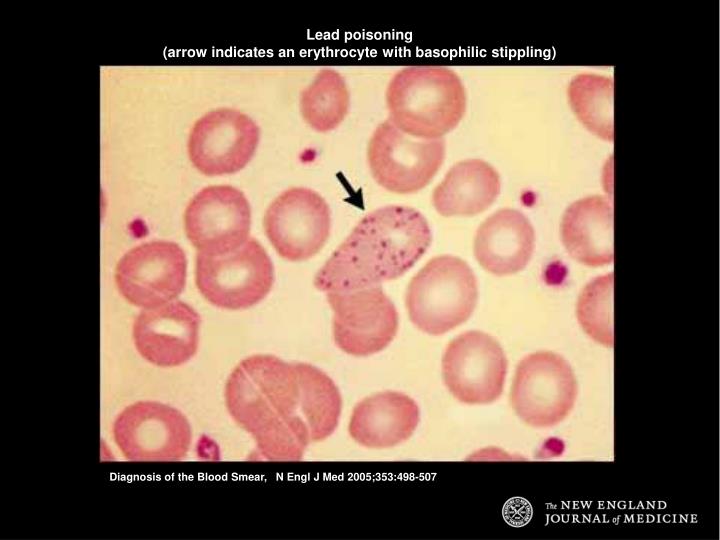 PPT - Diagnosis of the Blood Smear, N Engl J Med 2005;353:498-507 ...