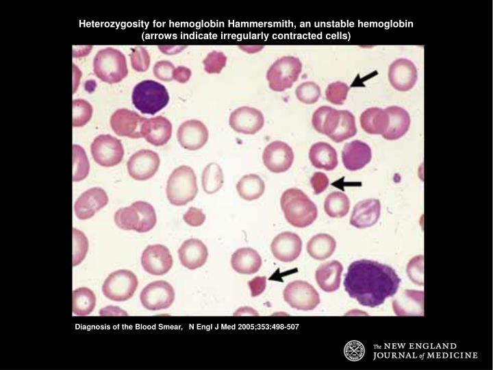 PPT - Diagnosis of the Blood Smear, N Engl J Med 2005;353:498-507 ...