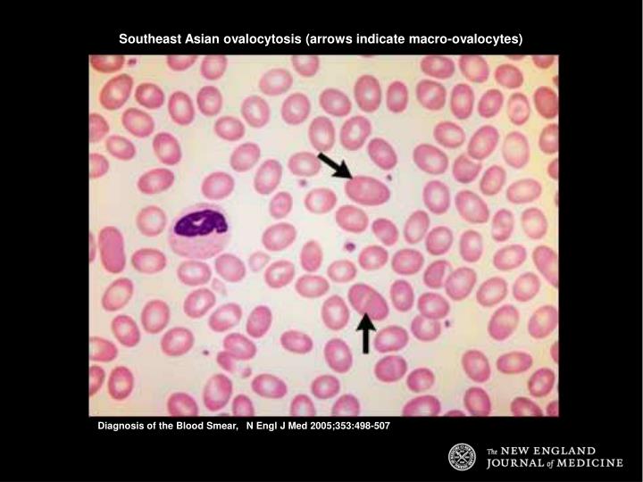 PPT - Diagnosis of the Blood Smear, N Engl J Med 2005;353:498-507 ...