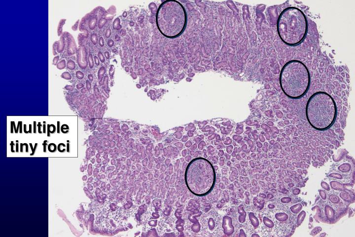 PPT - Lymphocytic Gastritis PowerPoint Presentation - ID:5120914