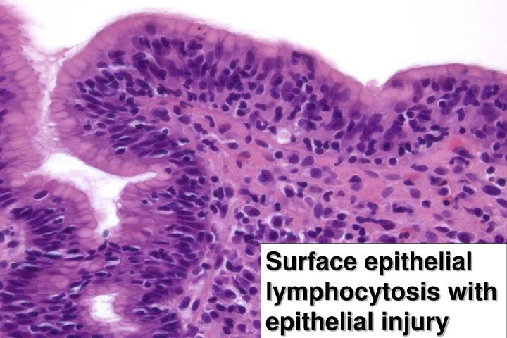 PPT - Lymphocytic Gastritis PowerPoint Presentation - ID:5120914