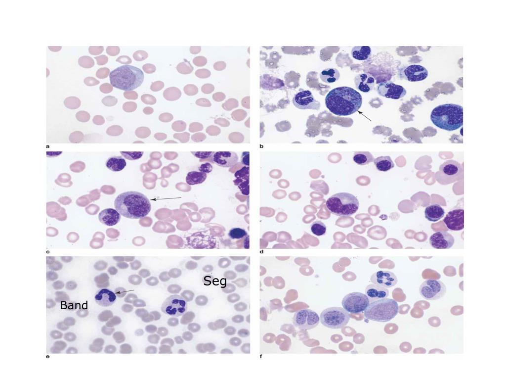 PPT - MLAB 1415- Hematology Keri Brophy-Martinez PowerPoint ...