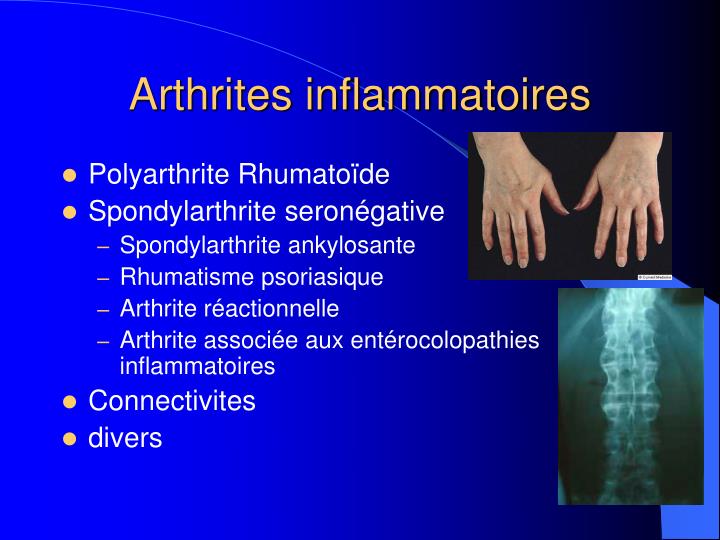 PPT - Prise en charge d’une arthrite aiguë PowerPoint Presentation - ID ...