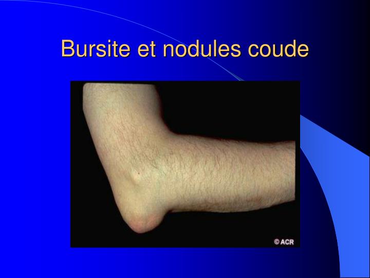 PPT - Prise en charge d’une arthrite aiguë PowerPoint Presentation - ID ...