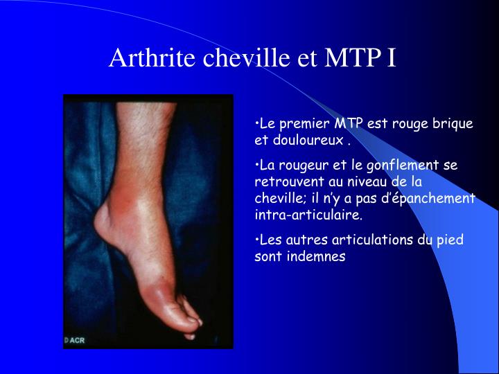 PPT - Prise en charge d’une arthrite aiguë PowerPoint Presentation - ID ...