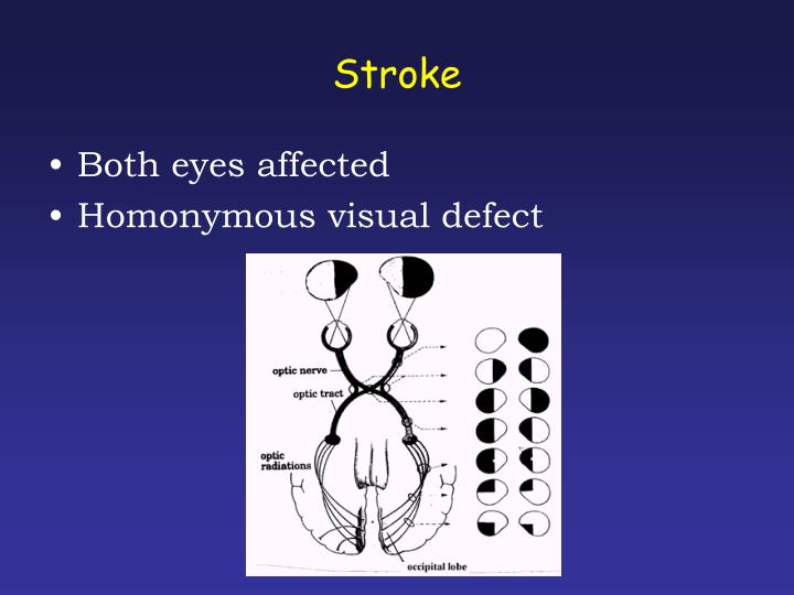 PPT - Back to Basics Ophthalmology: Acute visual disturbance/loss ...