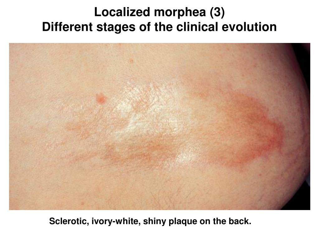 Ppt The Face In Diffuse Systemic Sclerosis Note The Radial Furrows
