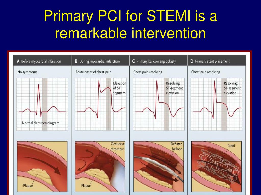 PPT - Redesigning Hospitals to Improve Quality The Door-to-Balloon A ...