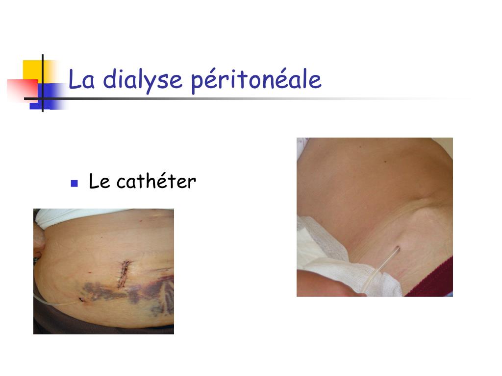 PPT - DIALYSE PERITONEALE: PRINCIPES, METHODES ET RÔLE INFIRMIER ...