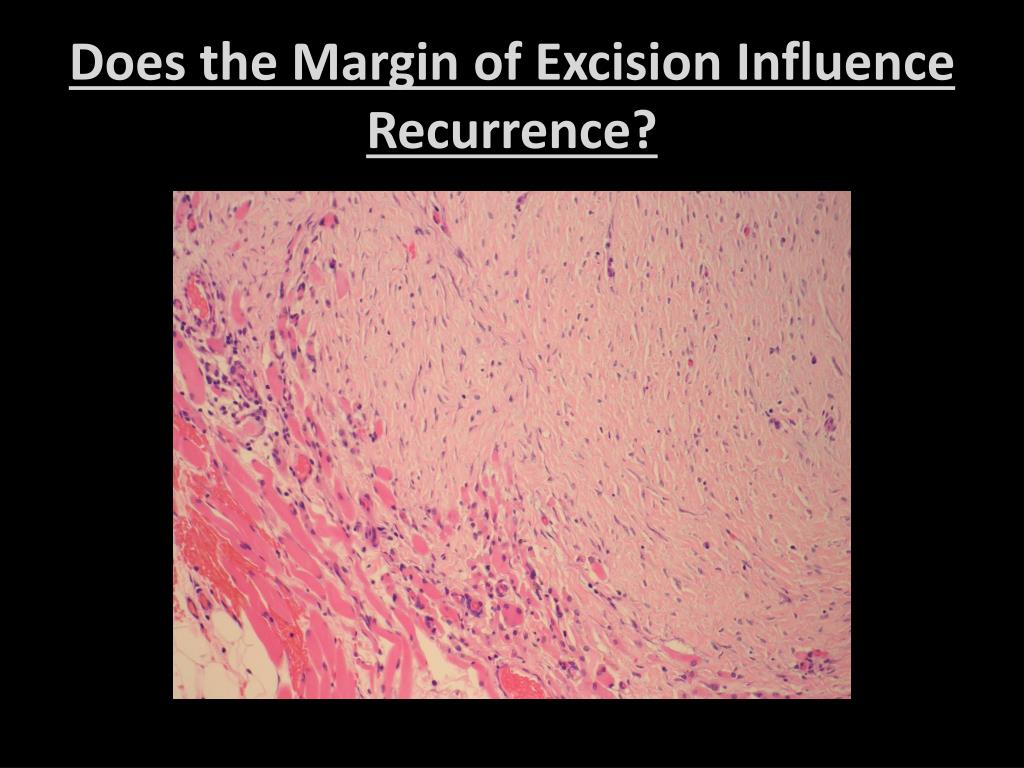PPT - Extra-Abdominal Fibromatosis : The Birmingham Experience ...
