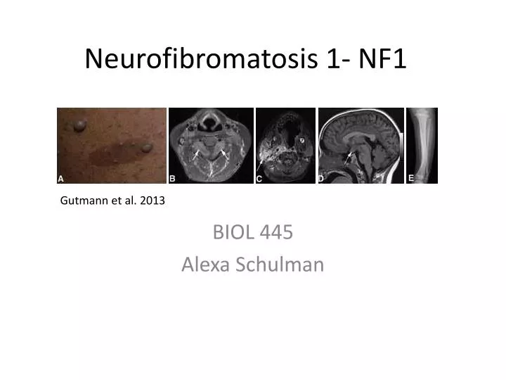 PPT - Neurofibromatosis 1- NF1 PowerPoint Presentation, free download - ID:5157795