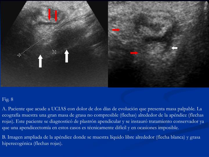 PPT - HALLAZGOS ECOGRÁFICOS DE LA APENDICITIS AGUDA Y SUS PRINCIPALES ...