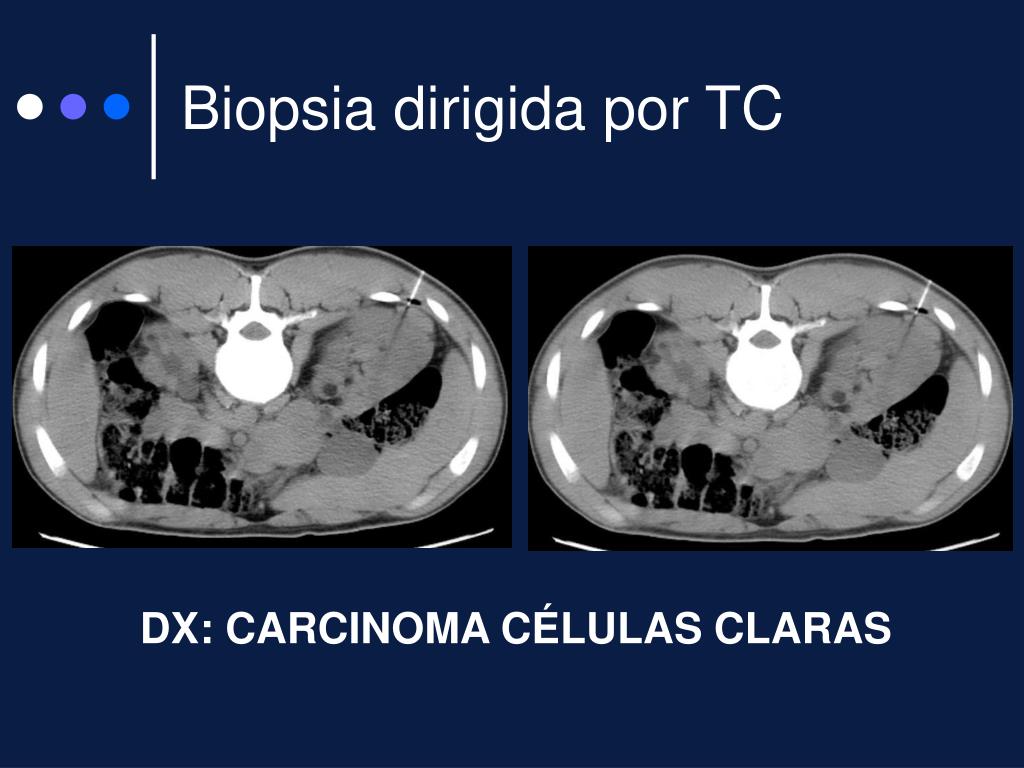 PPT - El TCMD en el diagnóstico de los tumores renales múltiples ...