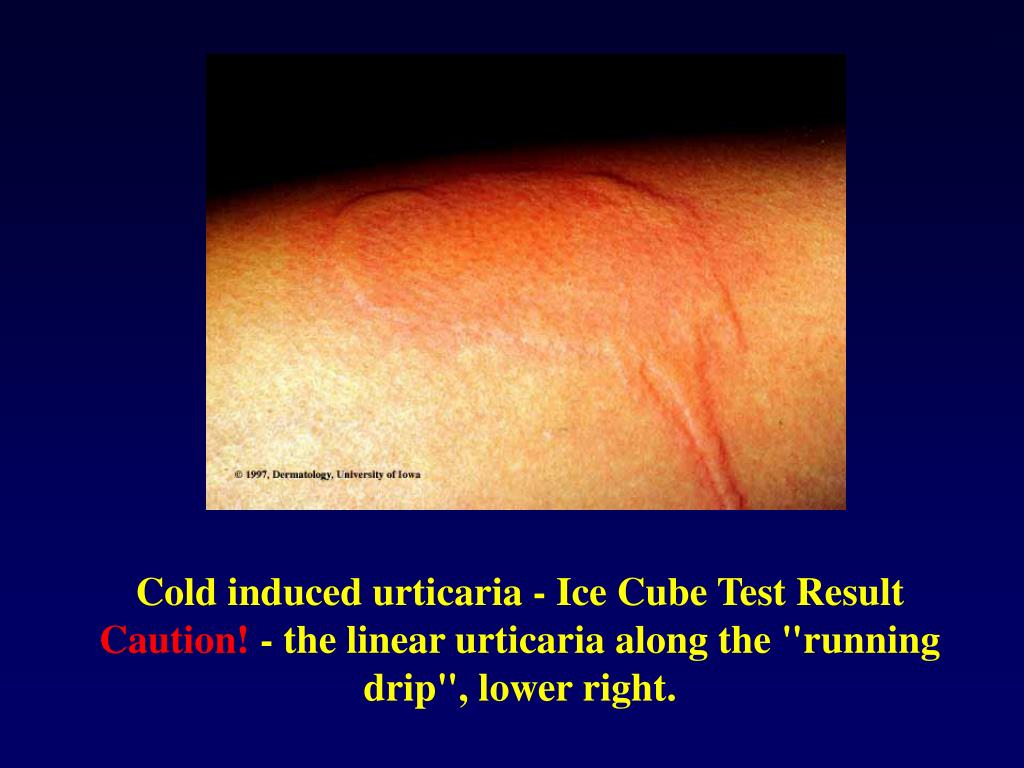 PPT - Allergic diseases – anaphylaxis a nd anaphylactoid reactions ...