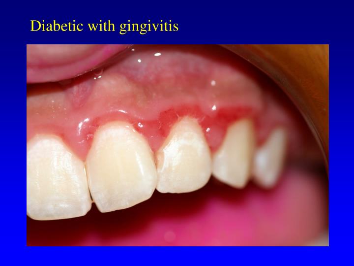 PPT - What is periodontal disease? How does it affect diabetes ...