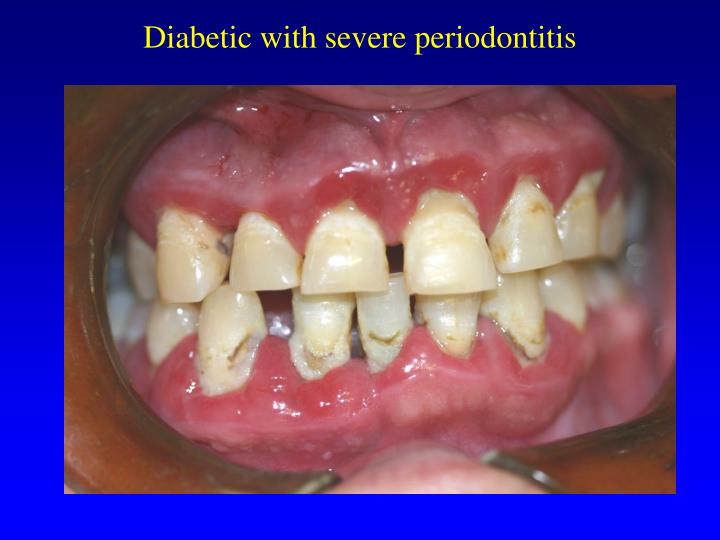 PPT - What is periodontal disease? How does it affect diabetes ...