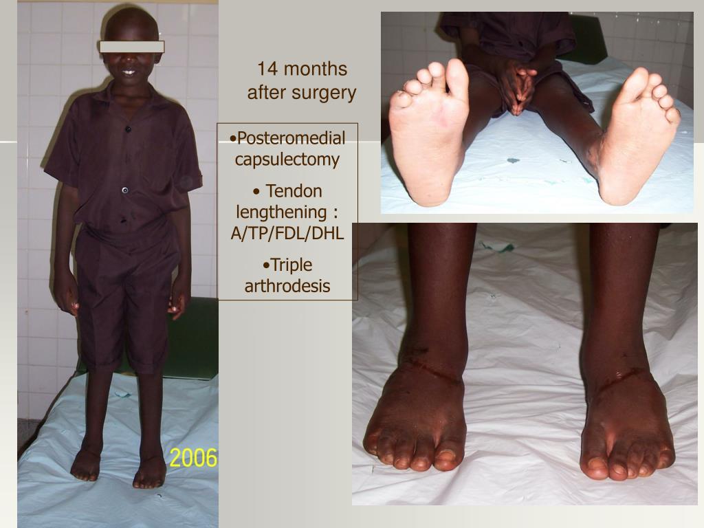 Ppt Treatment Of Clubfoot Deformities Powerpoint Presentation Free