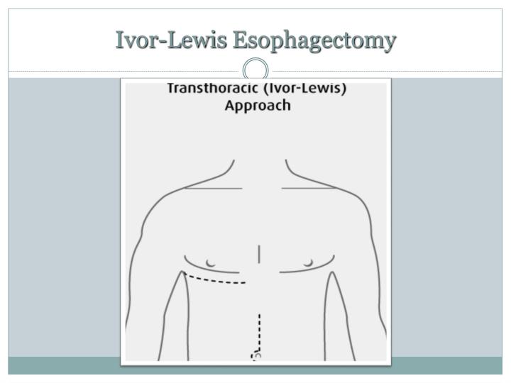 PPT - Diagnosis & Surgical Management of Esophageal Malignancies ...