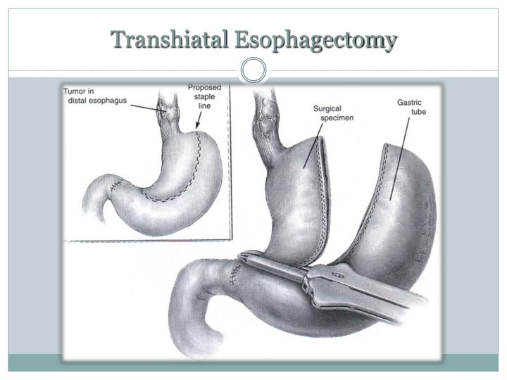 PPT - Diagnosis & Surgical Management of Esophageal Malignancies ...