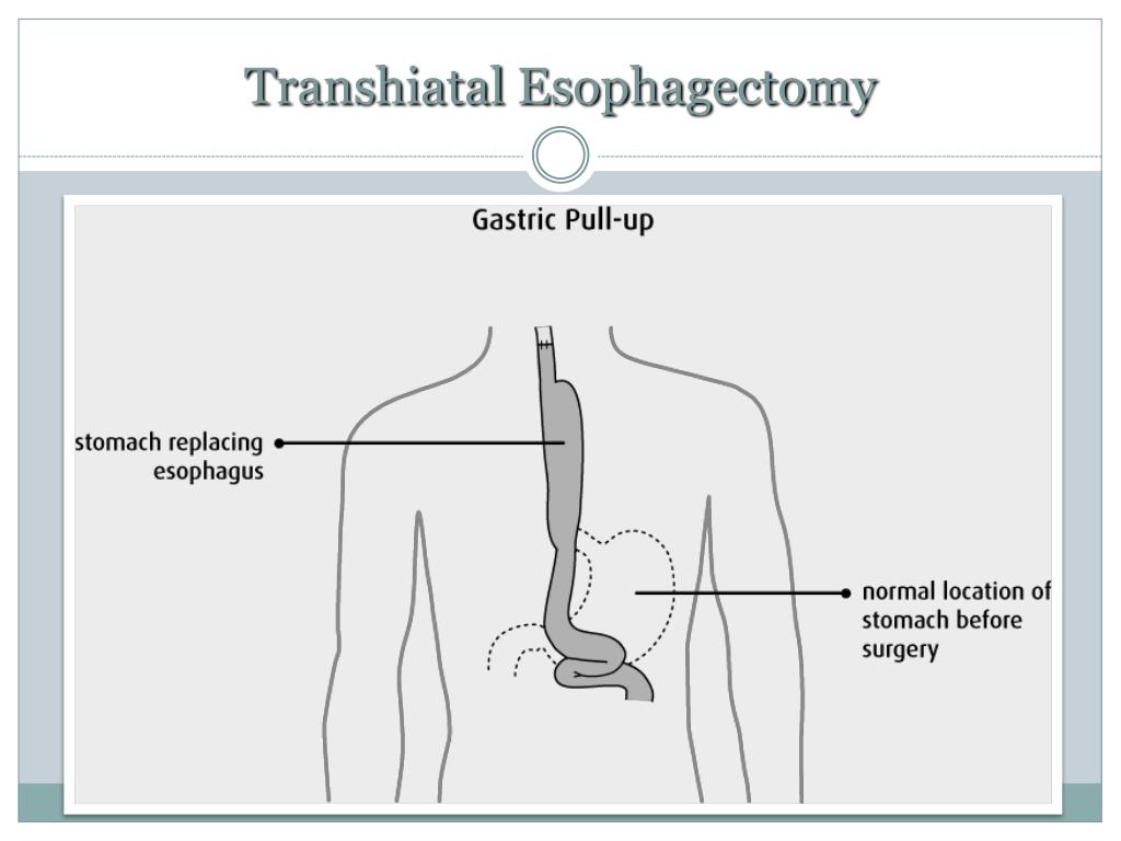 PPT - Diagnosis & Surgical Management of Esophageal Malignancies ...