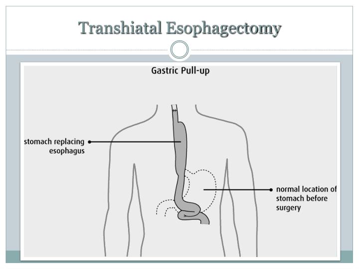 PPT - Diagnosis & Surgical Management of Esophageal Malignancies ...