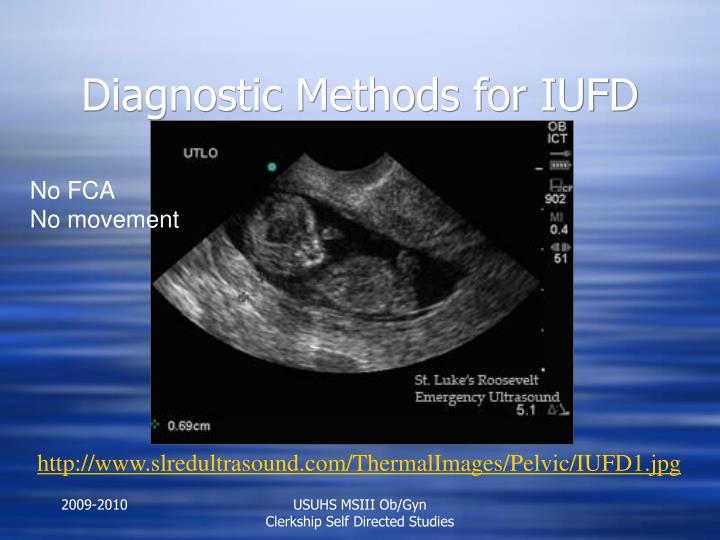 PPT - Fetal Death Ch 13 PowerPoint Presentation - ID:5180909