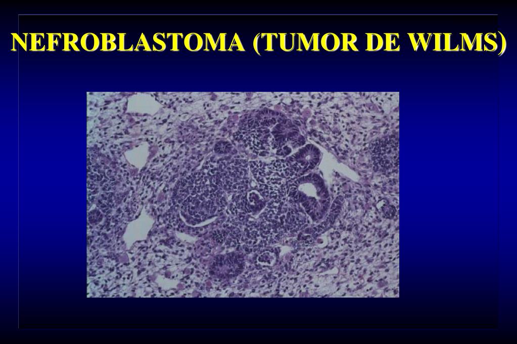 PPT - PATOLOGIA e BIOLOGIA MOLECULAR do CÂNCER RENAL PowerPoint ...