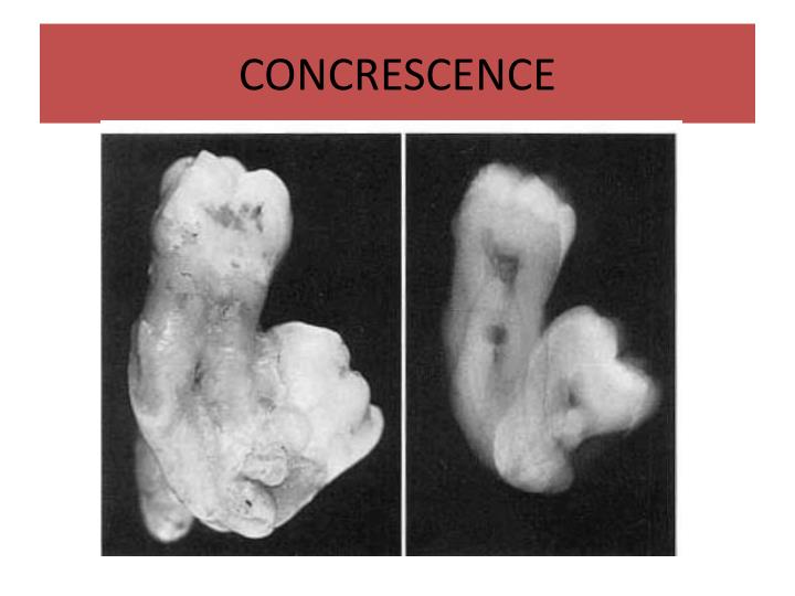 PPT - DENTAL ANOMALY PowerPoint Presentation - ID:5189746