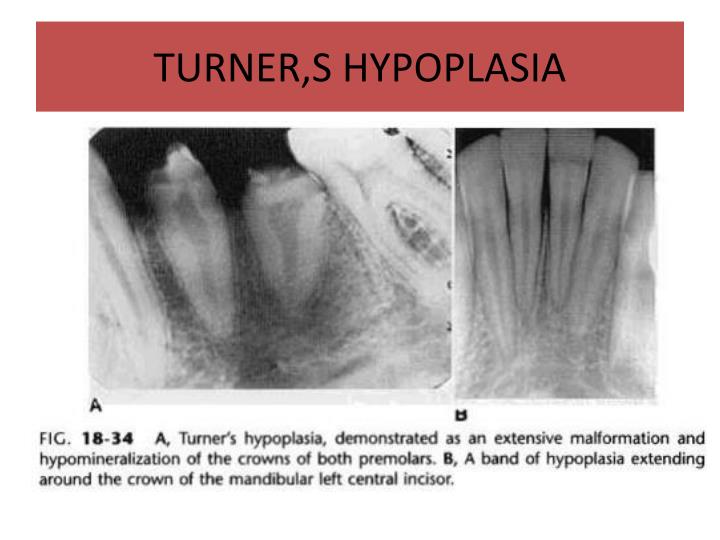 PPT - DENTAL ANOMALY PowerPoint Presentation - ID:5189746