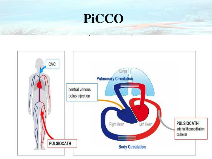 PPT - MONITORIZACION HEMODINAMICA: PiCCO PowerPoint Presentation - ID ...