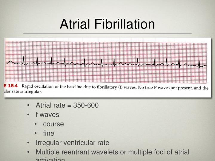 PPT - Atrial Flutter and Atrial Fibrillation PowerPoint Presentation ...
