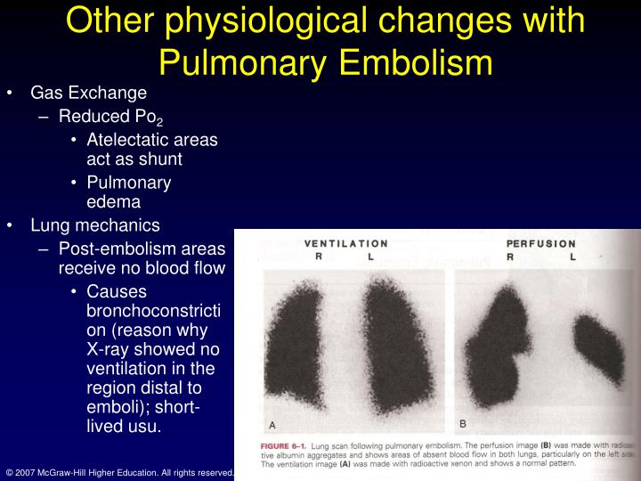 PPT - Chapter 6 Pulmonary Embolism PowerPoint Presentation - ID:5190931
