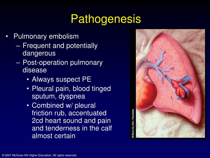 PPT - Chapter 6 Pulmonary Embolism PowerPoint Presentation - ID:5190931