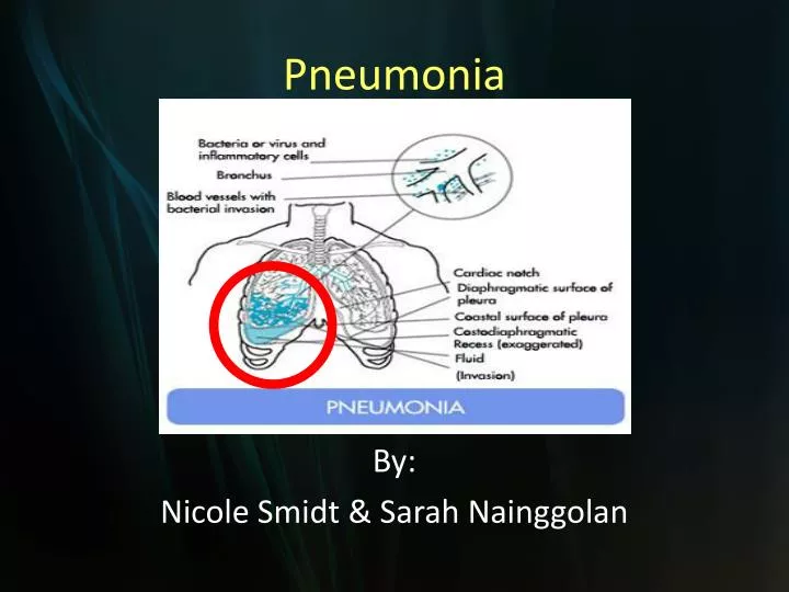 PPT - Pneumonia PowerPoint Presentation, free download - ID:5196924