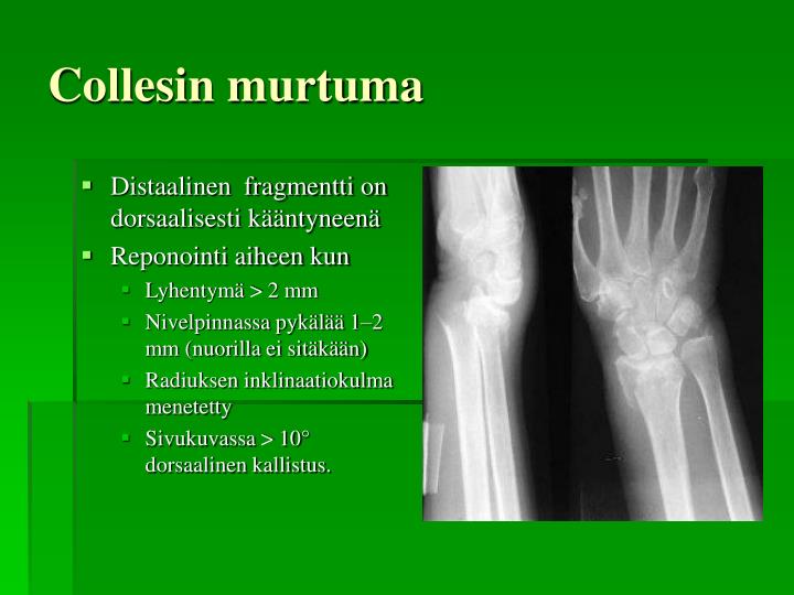 PPT - Käden alueen vammoja perusterveydenhuollon päivystyksessä ...