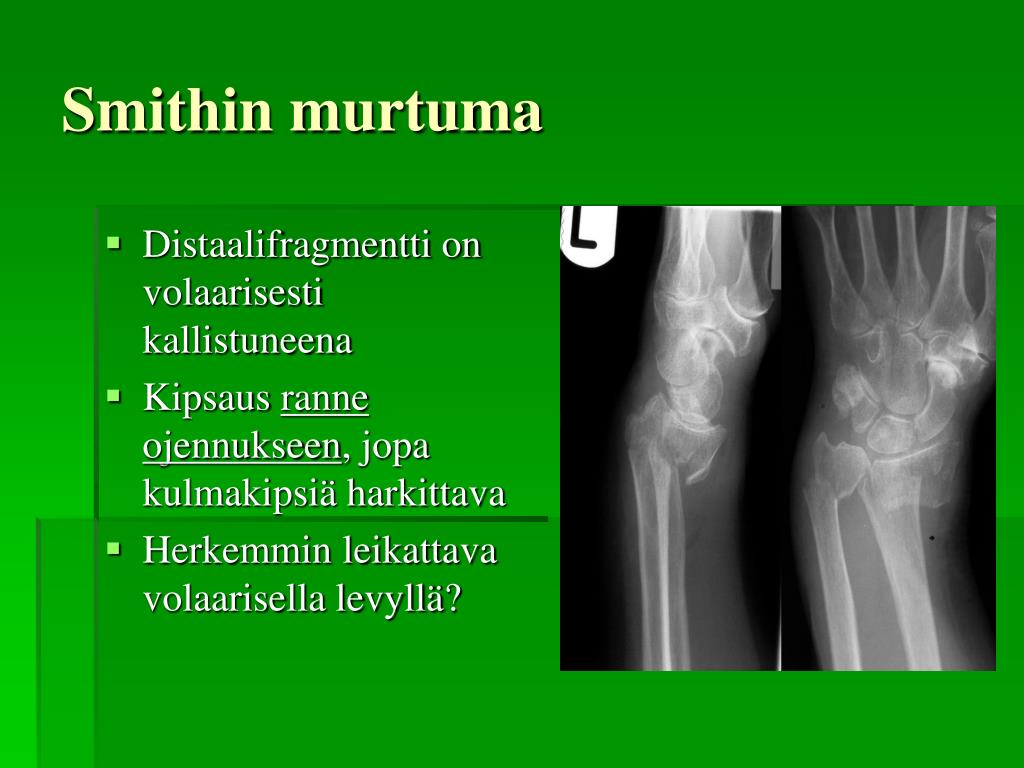 PPT - Käden alueen vammoja perusterveydenhuollon päivystyksessä ...