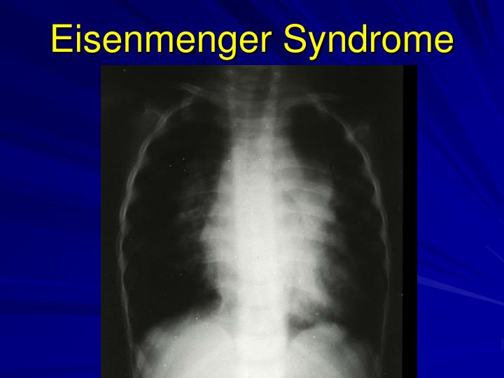 PPT - Eisenmenger Syndrome in Adults with Congenital Heart Disease ...