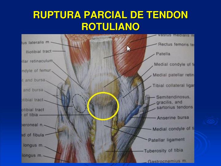 PPT - TRATAMIENTO PARA ARTRITIS DEGENERATIVA Y RUPTURA PARCIAL DE ...