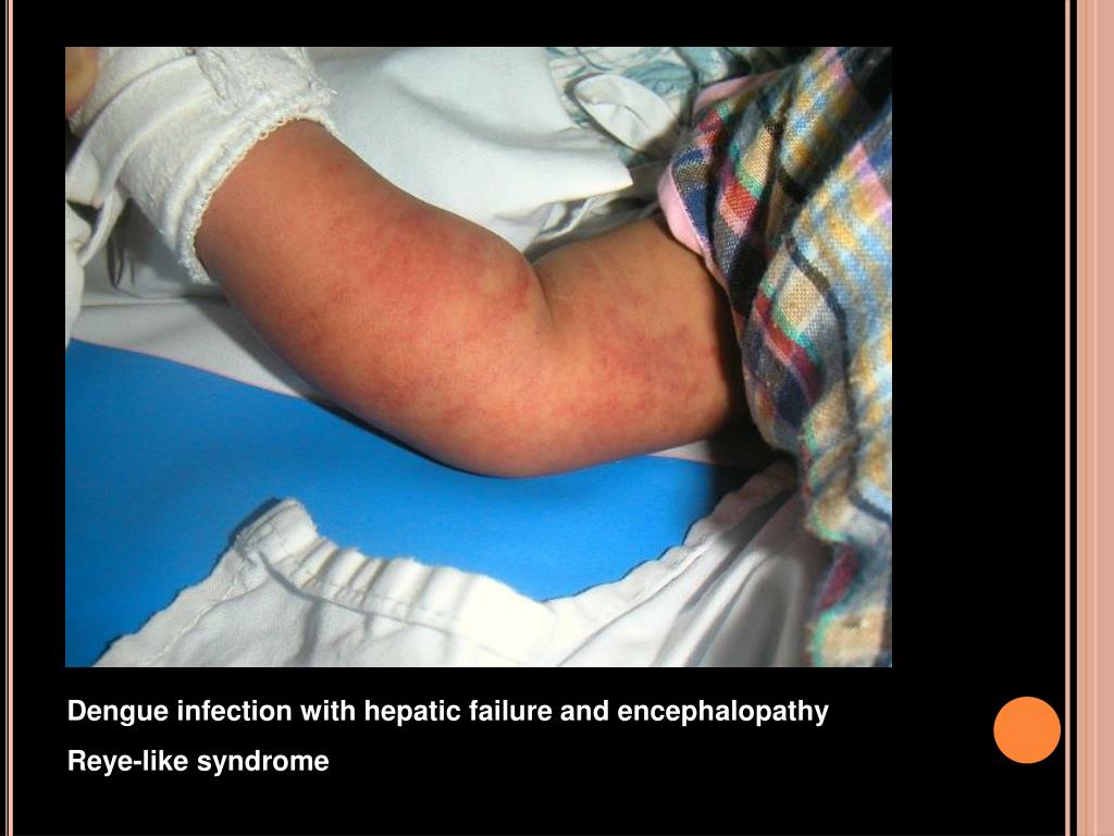 PPT - DENGUE HEMORRHADGIC FEVER DHF PowerPoint Presentation, free ...